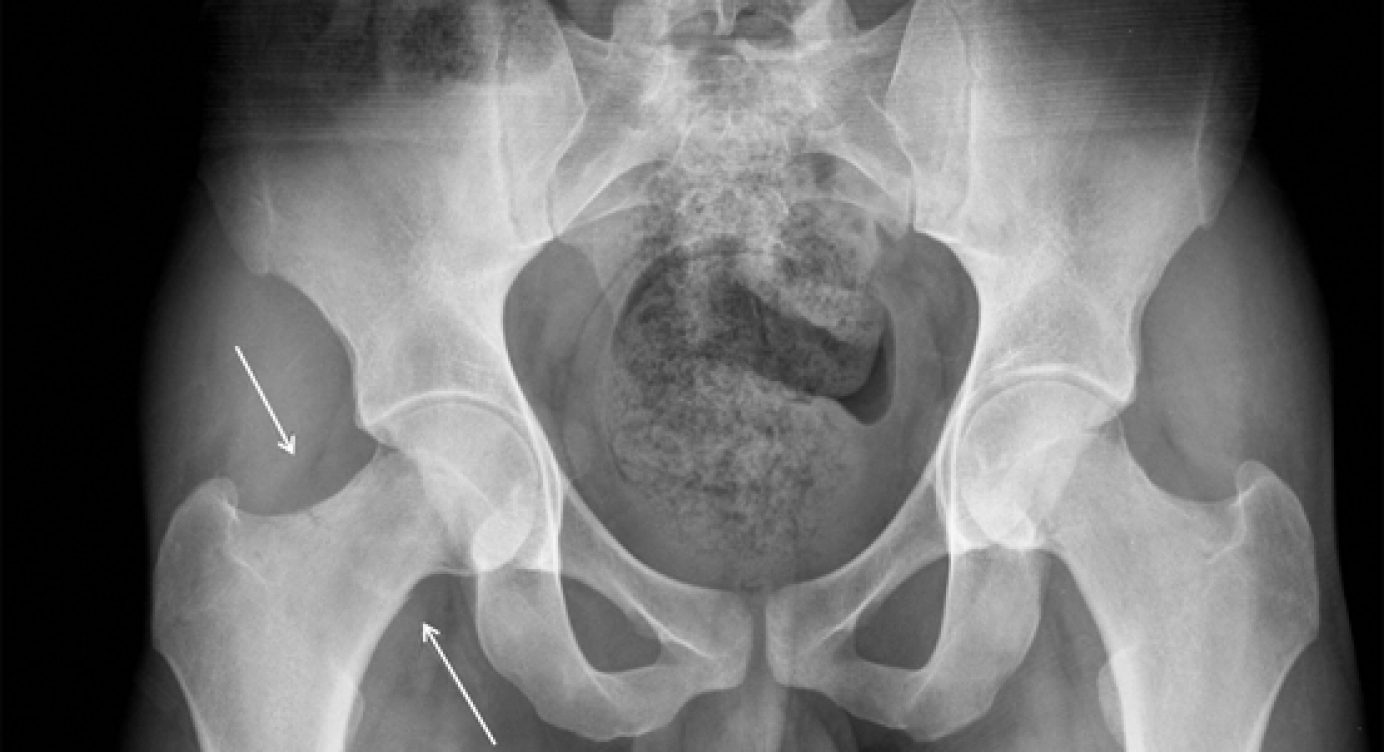 Non Displaced Cervical Fracture
